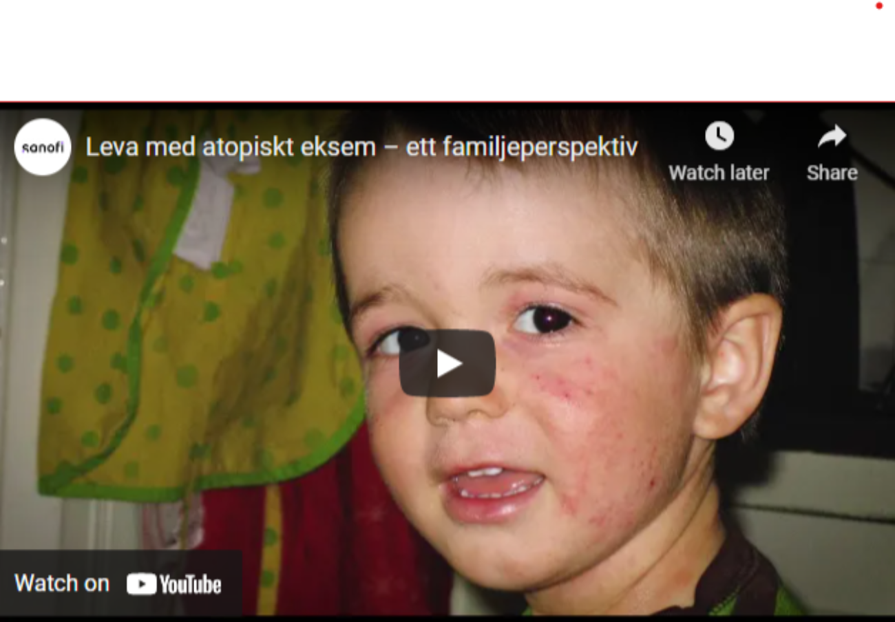 Att leva med atopiska eksem| Atopiker.se by Sanofi