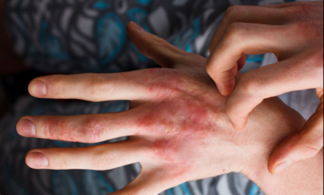 Vad är atopiskt eksem? | Atopiker.se by Sanofi